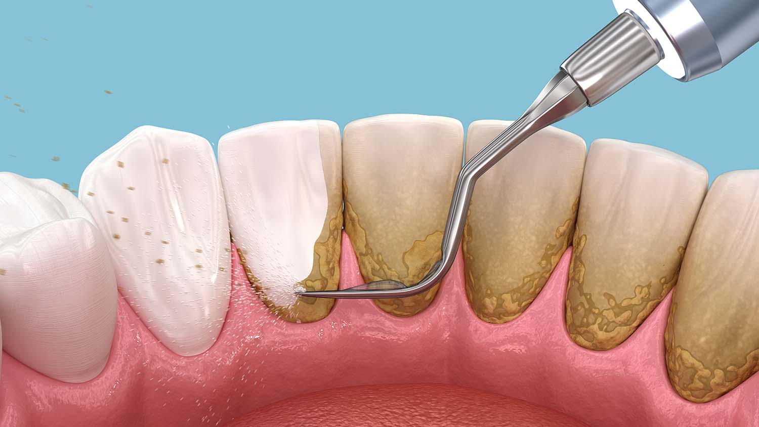 How to Remove Dental Plaque: A Comprehensive Guide - Elana Lisa & The ...